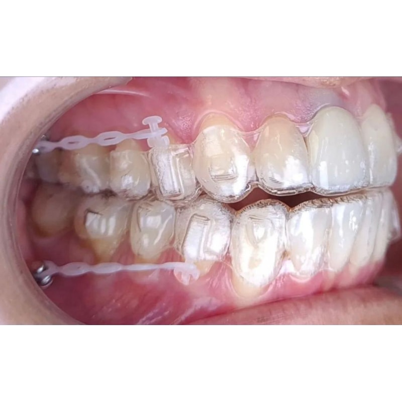 Botão Power Arm Cerâmico | Infinity | Orthoghia