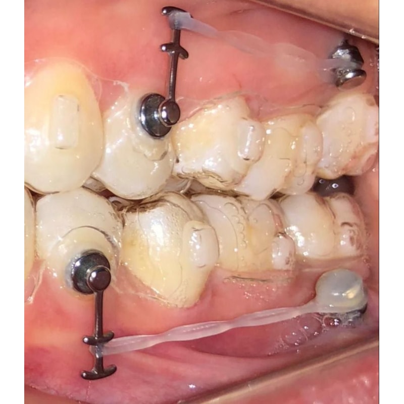 Botão Power Arm Metálico | Infinity | Orthoghia