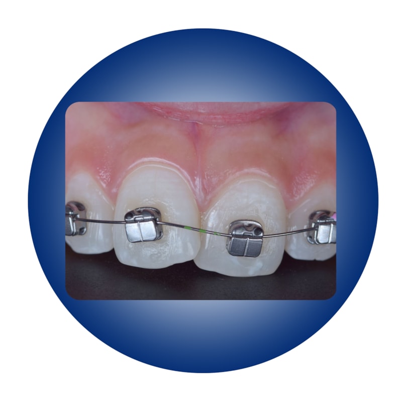 Bracket Carriere SLX Auto Ligado 022 5x5 - Orthoghia