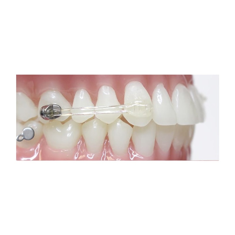 Carriere Motion 3D Clear Lado Esquerdo - Orthoghia
