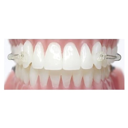 Carriere Motion 3D Clear Lado Esquerdo - Orthoghia