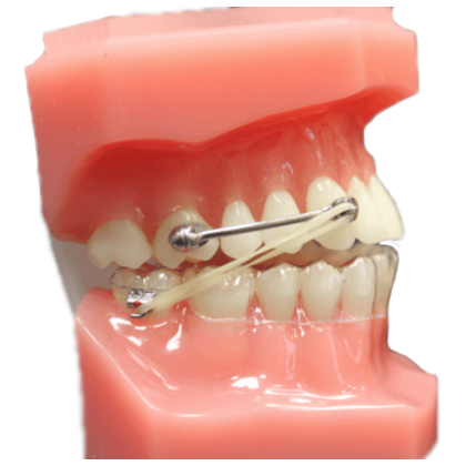 Carriere Motion 3D Metálico (Par) - Orthoghia