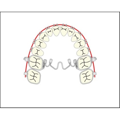 Twin-Force Bite Corrector Small - Orthoghia