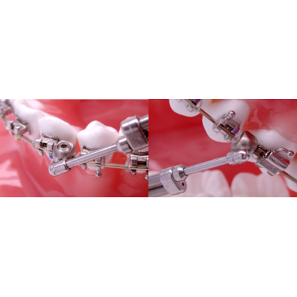 Twin-Force Bite Corrector Small - Orthoghia