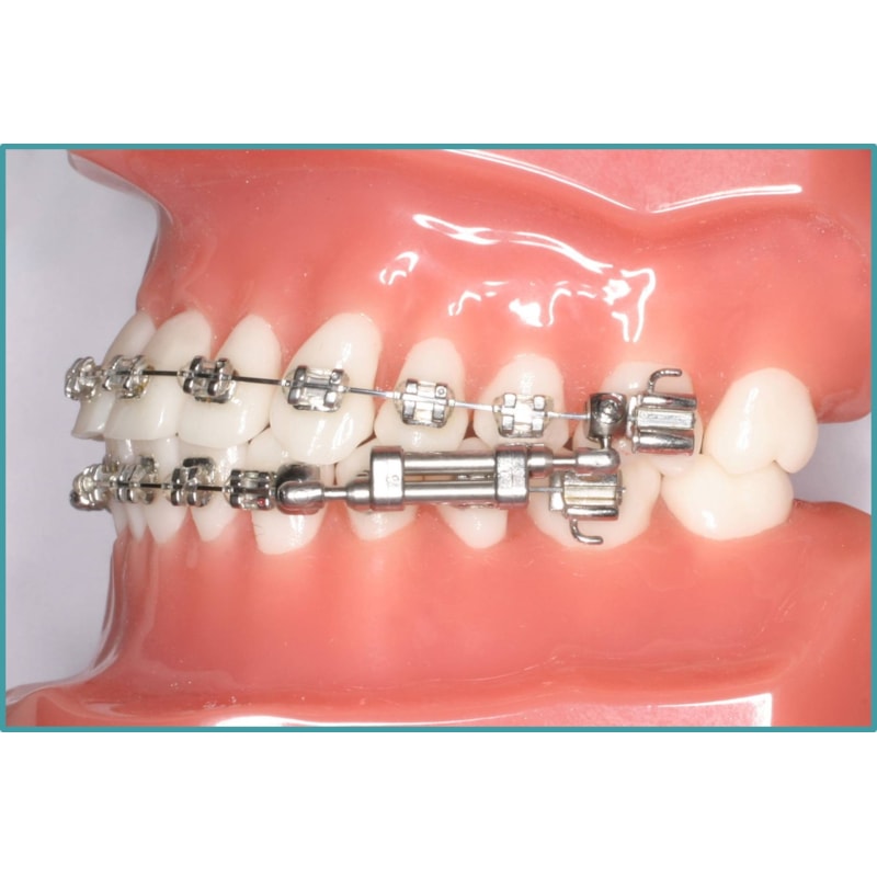 Twin-Force Bite Corrector Standard - Orthoghia