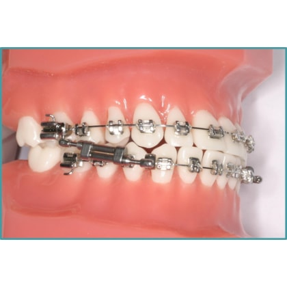 Twin-Force Bite Corrector Standard - Orthoghia