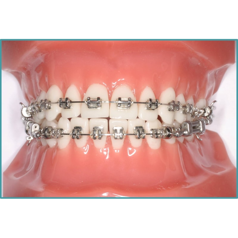 Twin-Force Bite Corrector Standard - Orthoghia